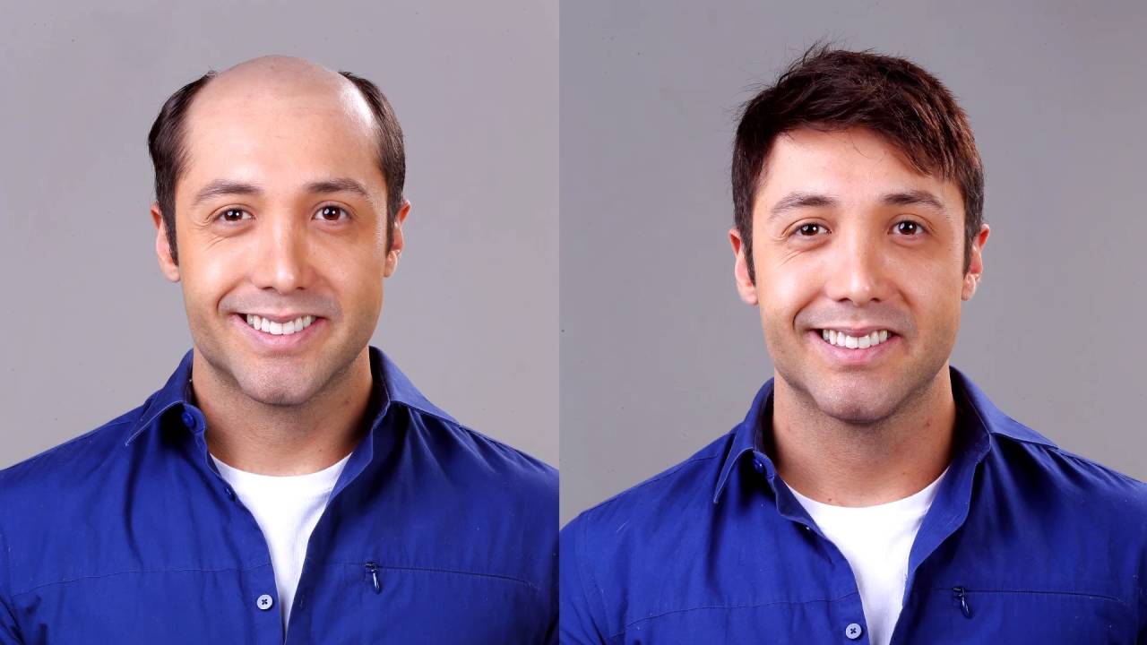 Prótese capilar: a nova onda que está fazendo a cabeça dos homens - O Papel